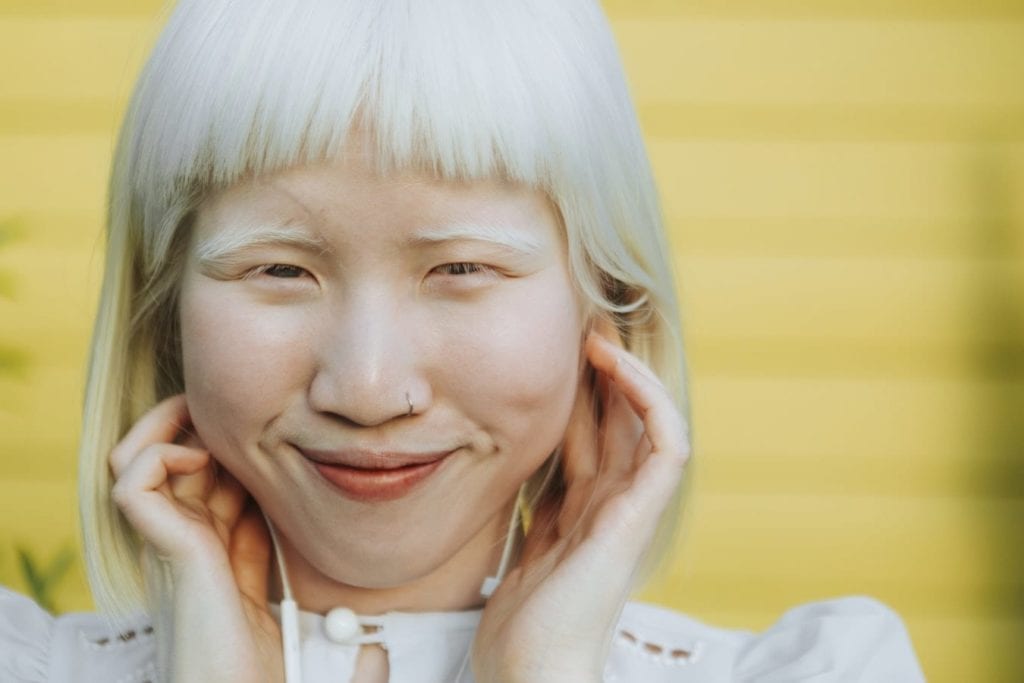 Albinism: Causes, Types, and Symptoms